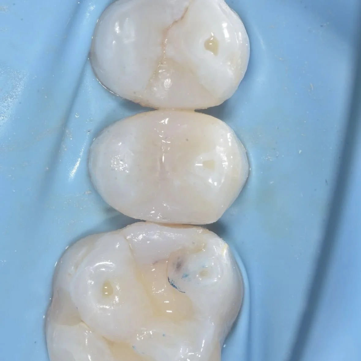 Understanding & Treating Deep Cavities — Alleman Center of Biomimetic ...