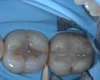 Margin Leakage in Restorative Dentistry — Alleman Center of Biomimetic ...