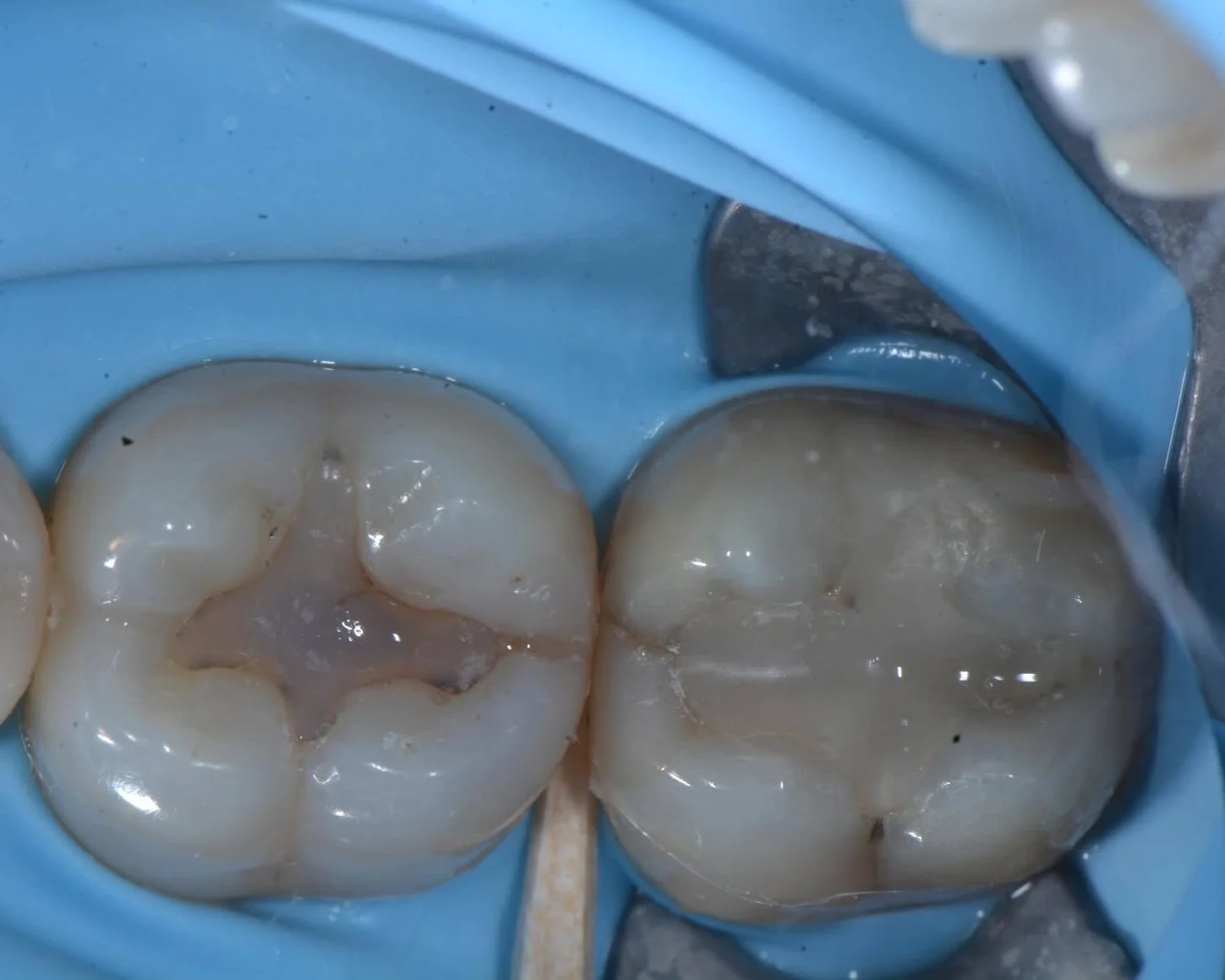 Margin Leakage in Restorative Dentistry — Alleman Center of Biomimetic ...