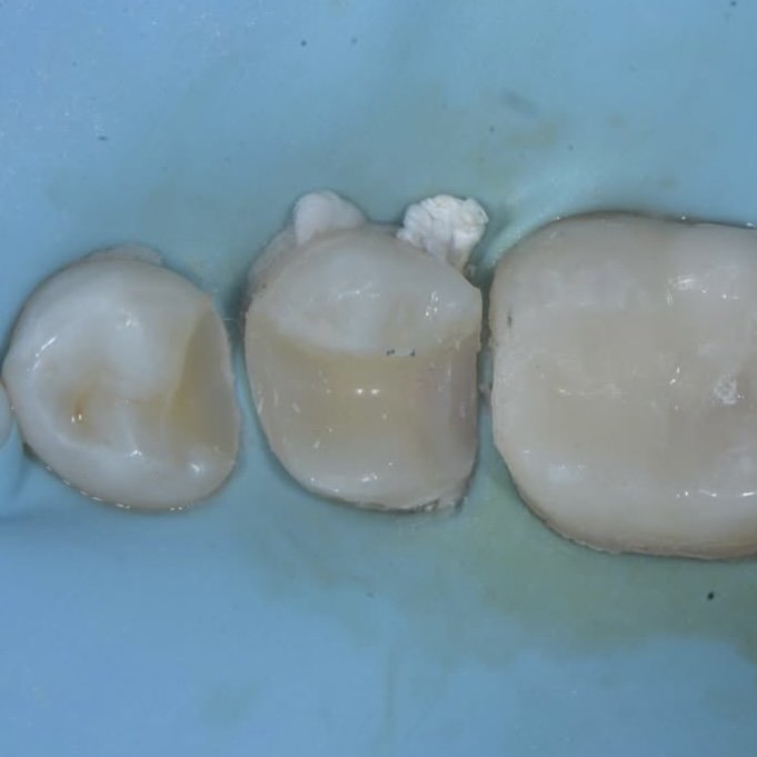 Conservative Alternatives to Crown Lengthening Surgery — Alleman Center ...