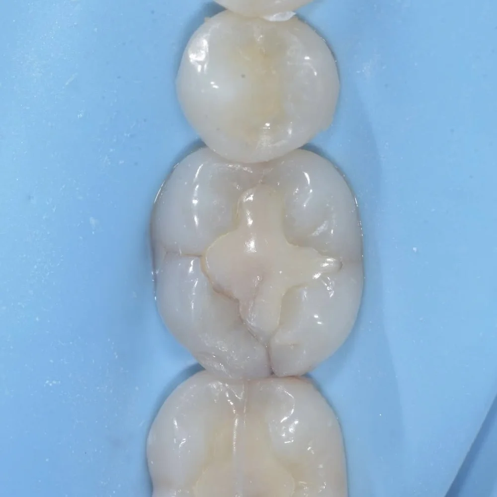 Post-operative Dental Sensitivity: Causes and Treatment — Alleman ...