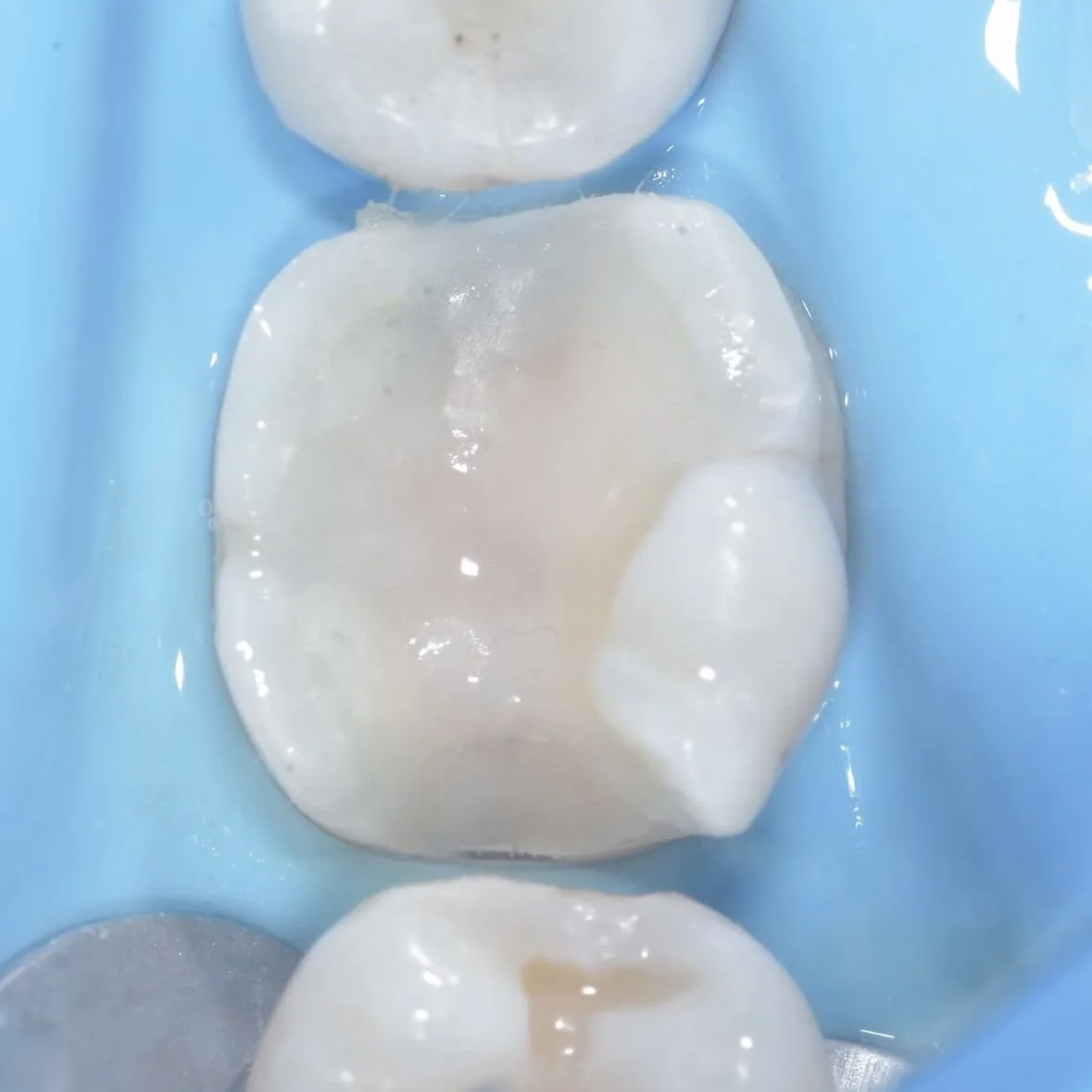 Decoupling with Time (DWT) — Alleman Center of Biomimetic Dentistry