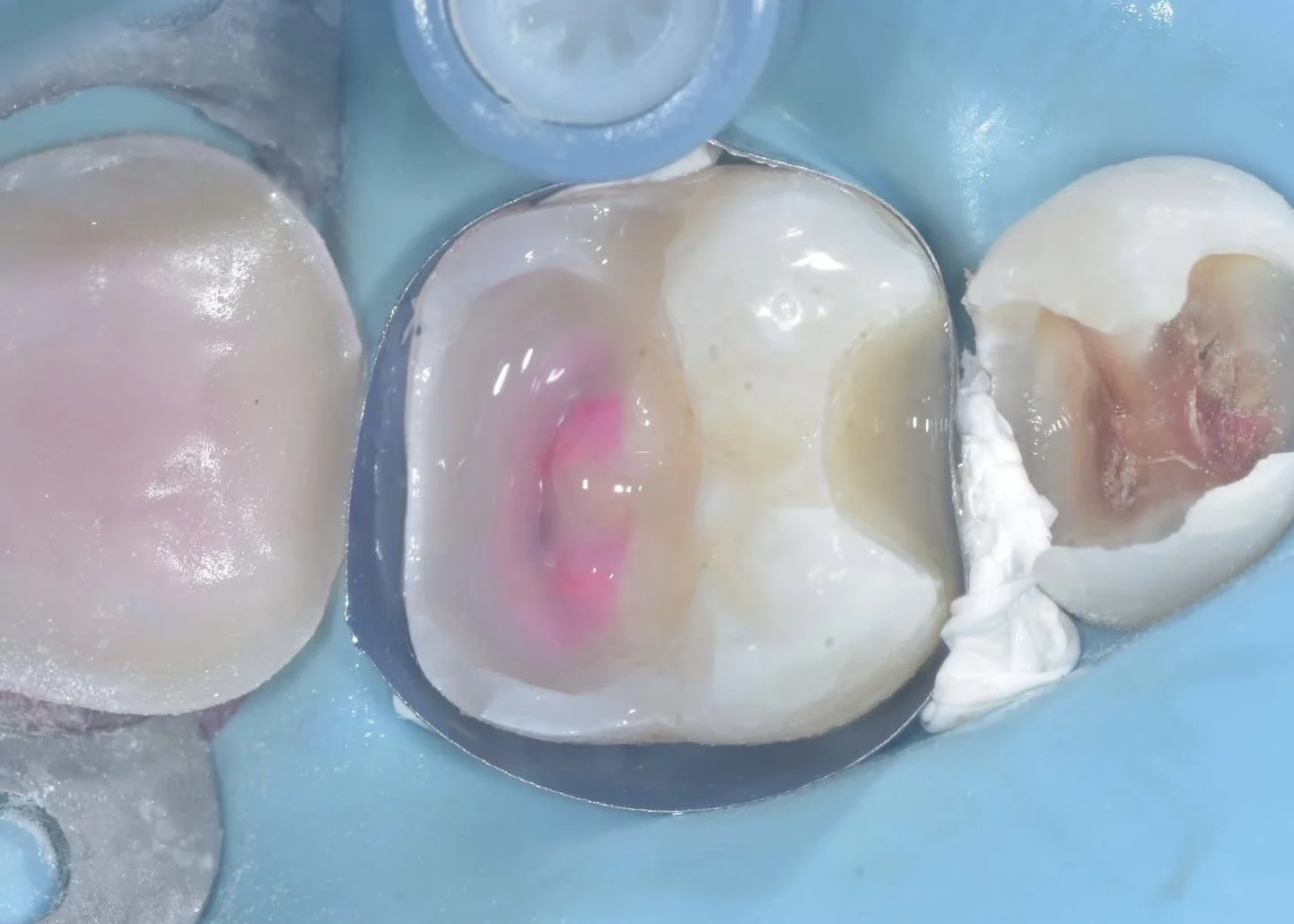 Immediate Dentin Sealing (IDS) — Alleman Center of Biomimetic Dentistry