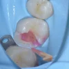 Caries Detector Dye (CDD): Increase Bond Strength and Protect the Pulp ...