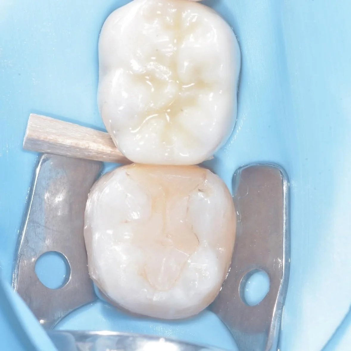 Lesson 3: Immediate Dentin Sealing and Resin Coating — Alleman Center ...