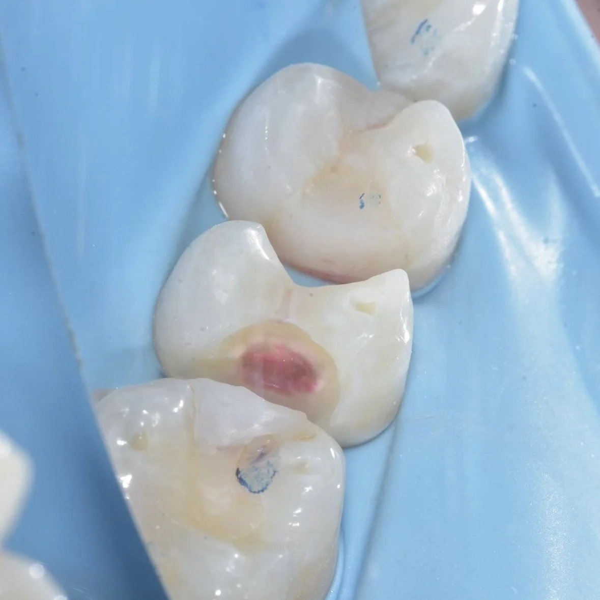 Understanding & Treating Deep Cavities — Alleman Center of Biomimetic ...