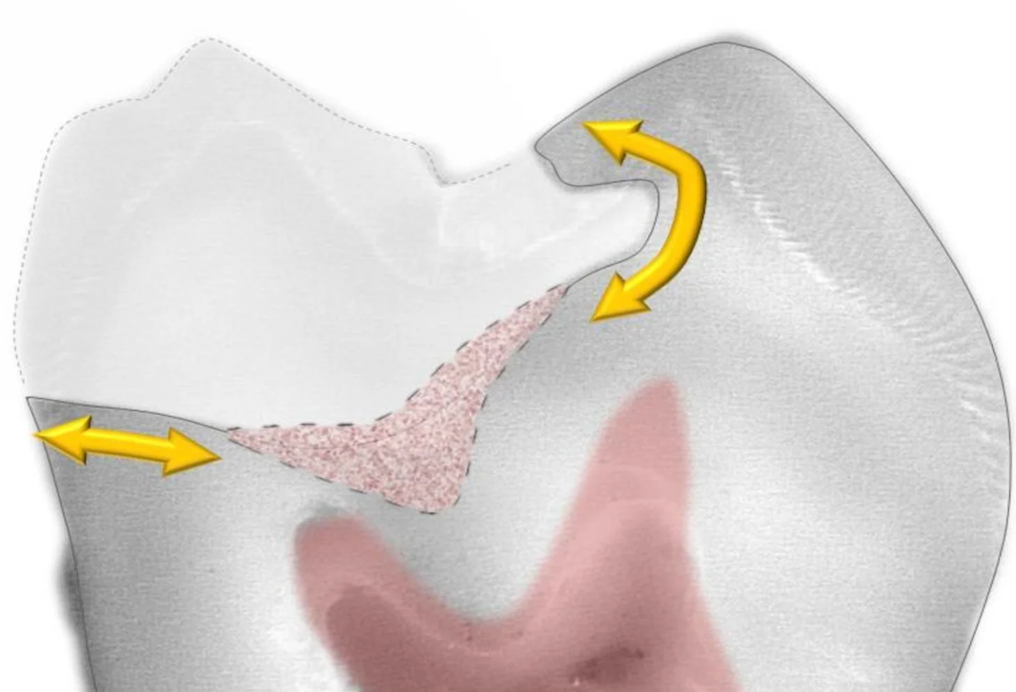 Understanding & Treating Deep Cavities — Alleman Center of Biomimetic ...