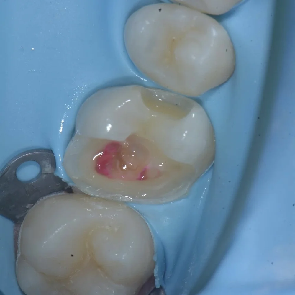 Caries Detector Dye (CDD): Increase Bond Strength and Protect the Pulp ...