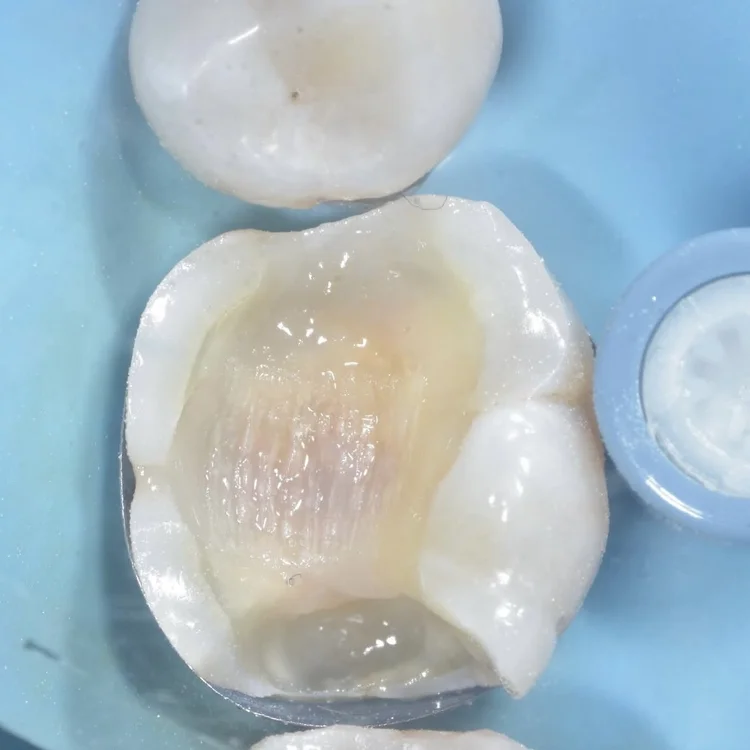 Decoupling with Time (DWT) — Alleman Center of Biomimetic Dentistry