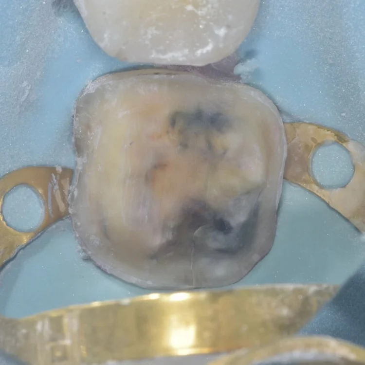 Crown Alternatives for Cracked Teeth — Alleman Center of Biomimetic ...