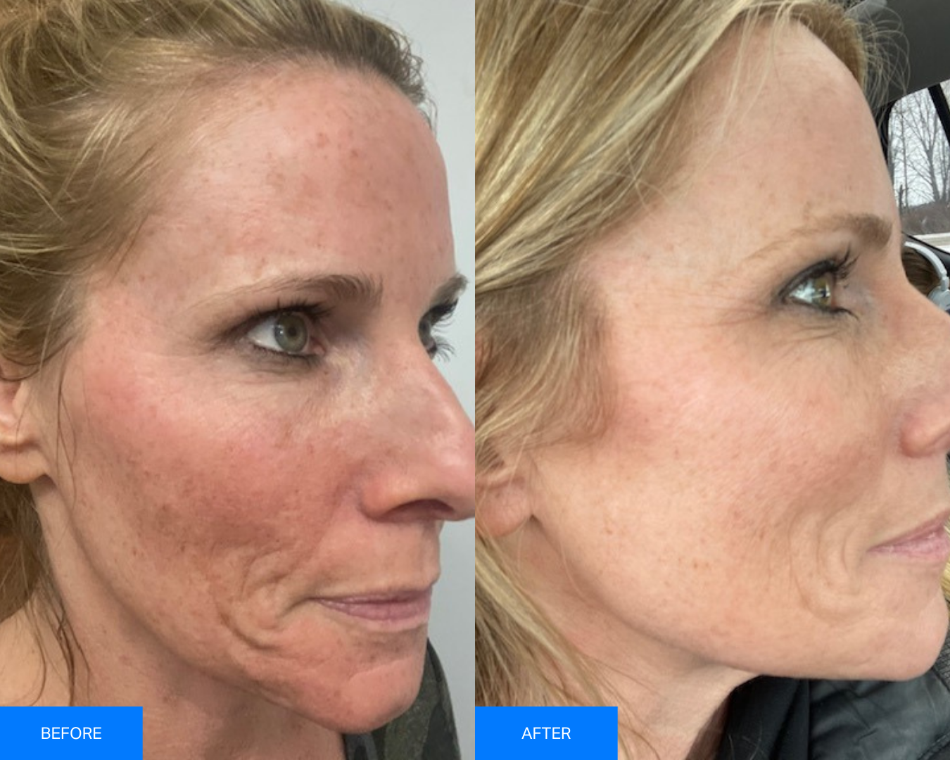 VI Peel®: What to Expect and Why It's Worth It — Remedy+ Hair ...