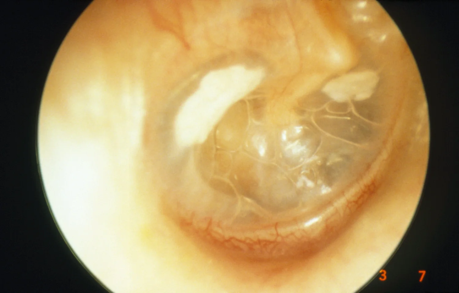 Serous Otitis Media — Doç. Dr. Onur Ergun, KBB, Istanbul, European ...