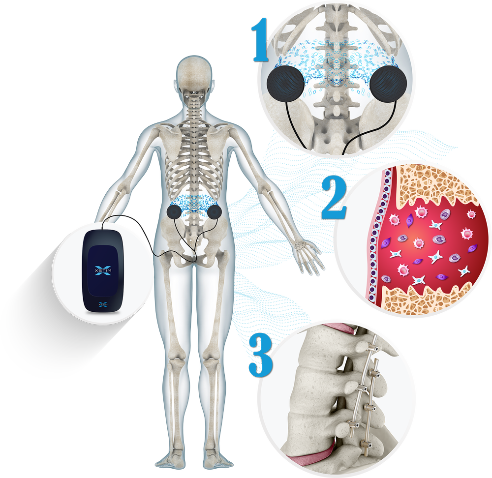 General 2 — Xstim, Spine Fusion Stimulation Therapy