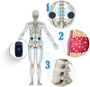 Xstim, Spine Fusion Stimulation Therapy