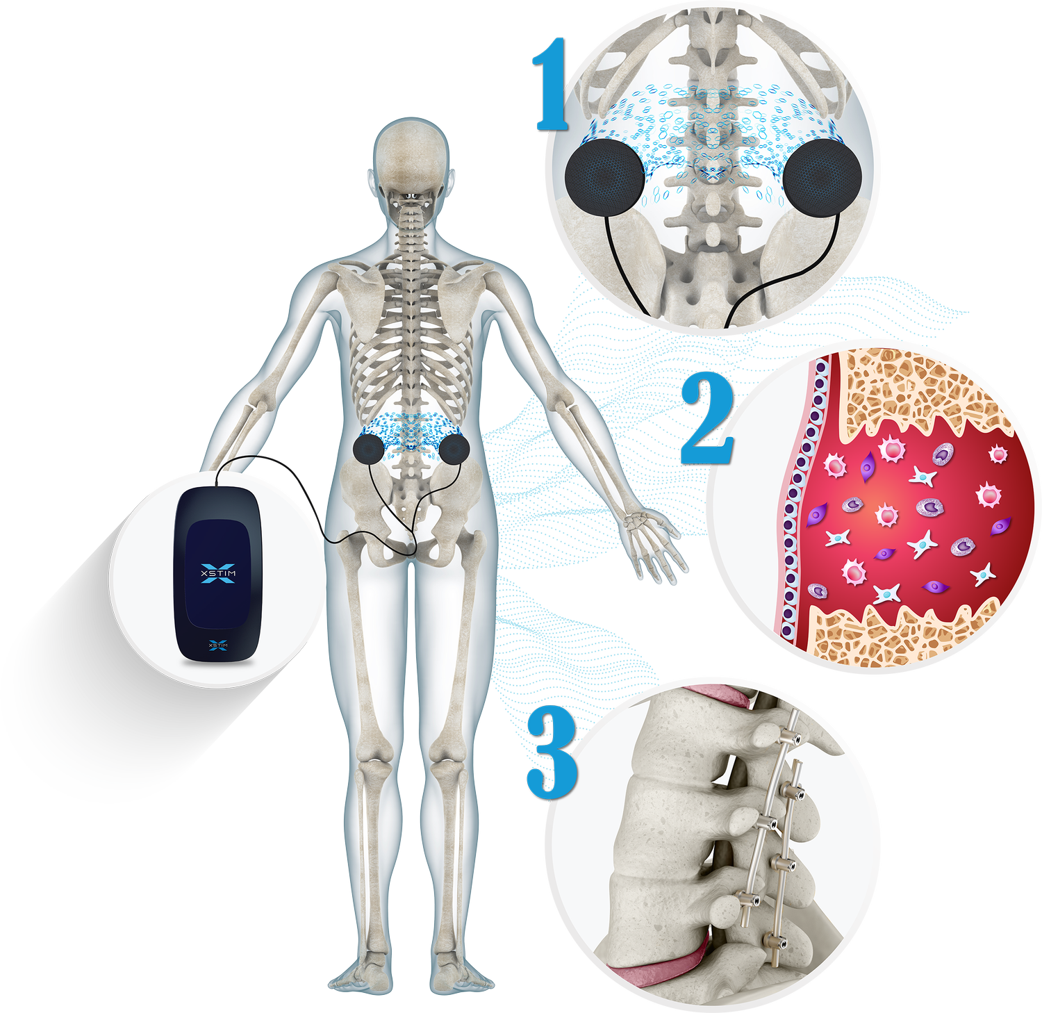 Xstim, Spine Fusion Stimulation Therapy