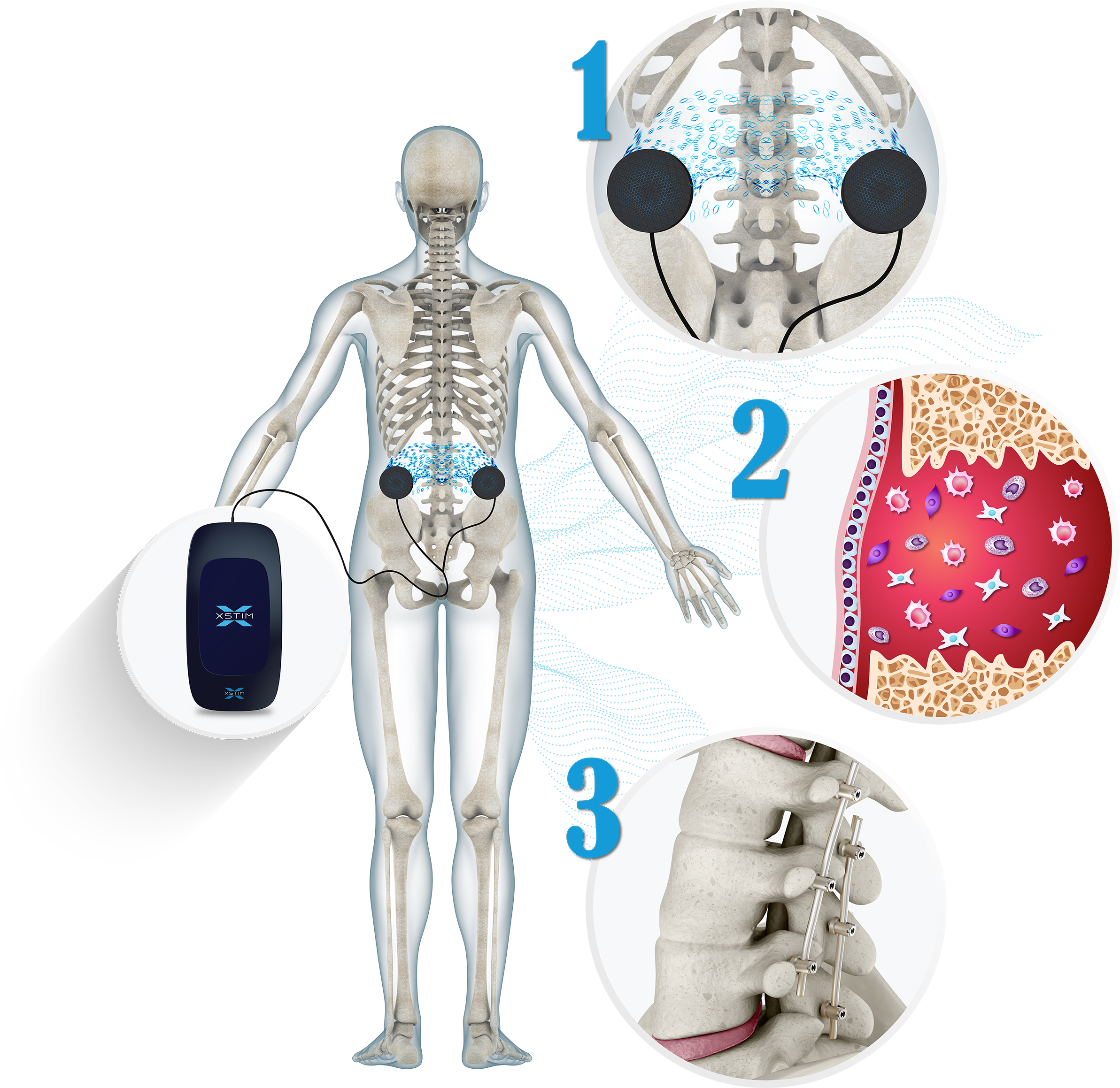 Xstim, Spine Fusion Stimulation Therapy