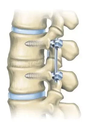 General 2 — Xstim, Spine Fusion Stimulation Therapy