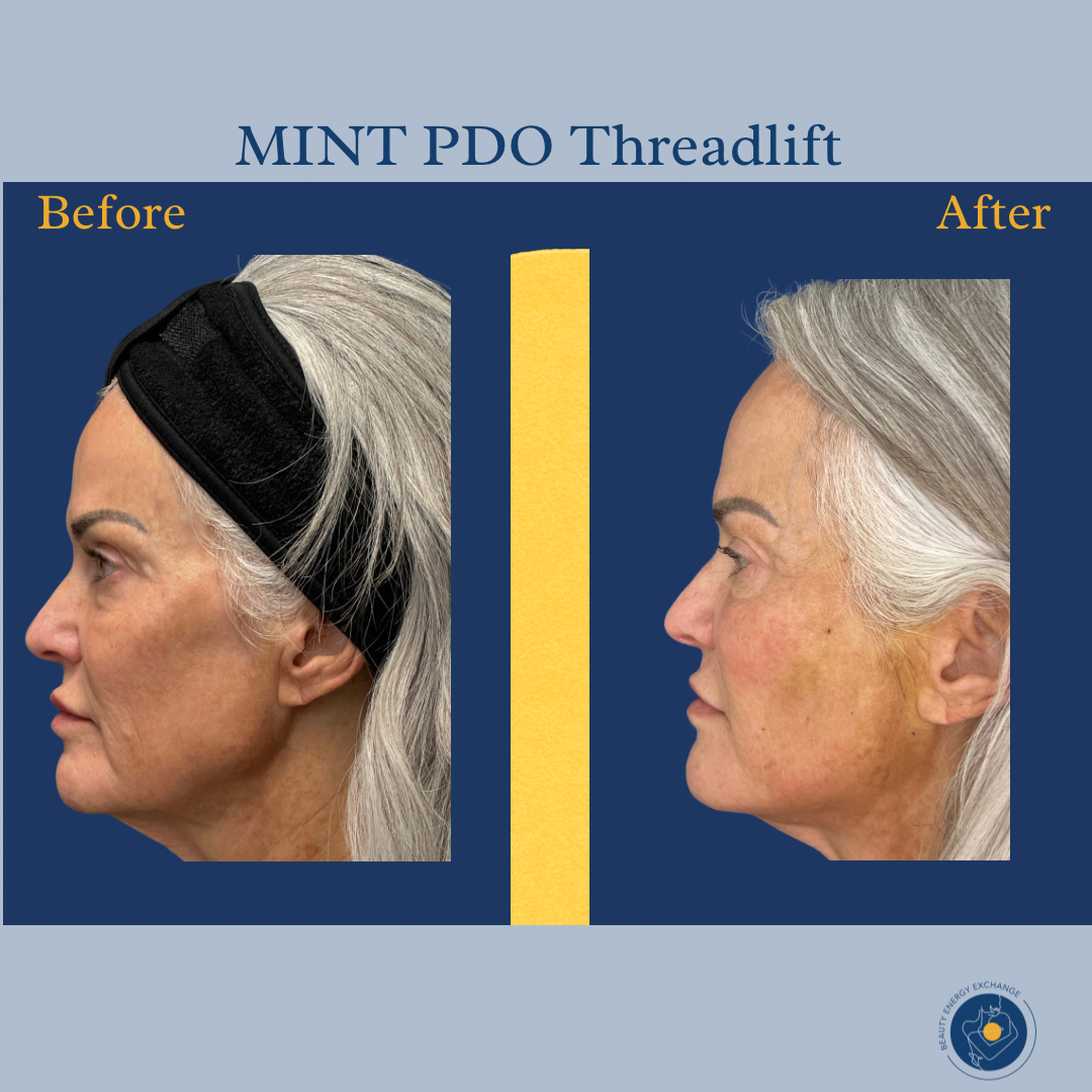 PDO Thread Lift San Diego | Beauty Energy Exchange San Diego — Beauty ...