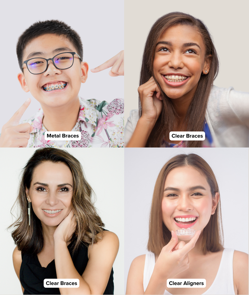 Types of Braces & Aligners — Orthodontic Specialists
