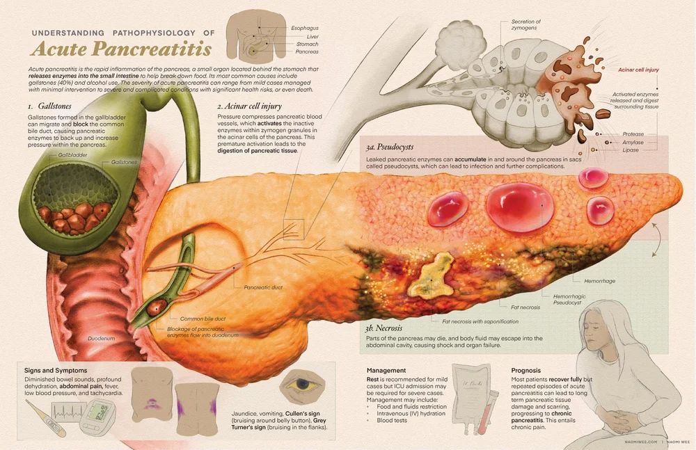 Pathology: Acute Pancreatitis — naomi wee