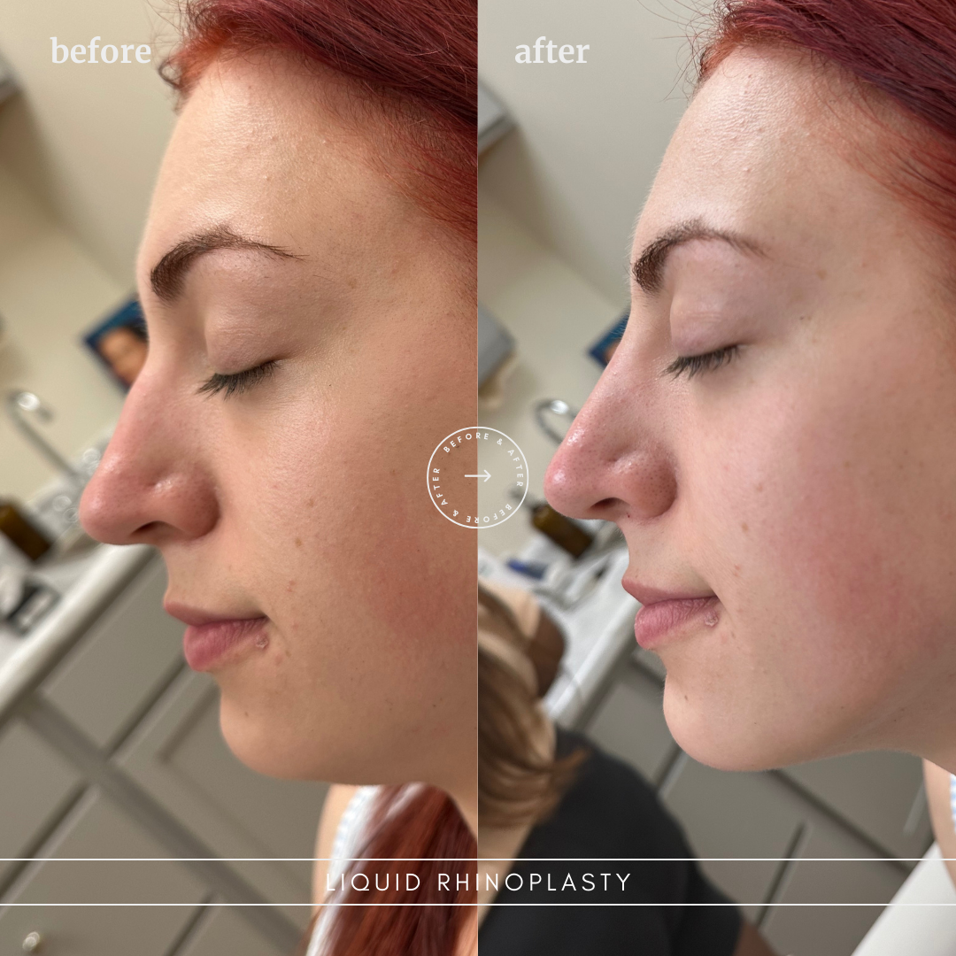 Dermal Filers — Excolo Medicine