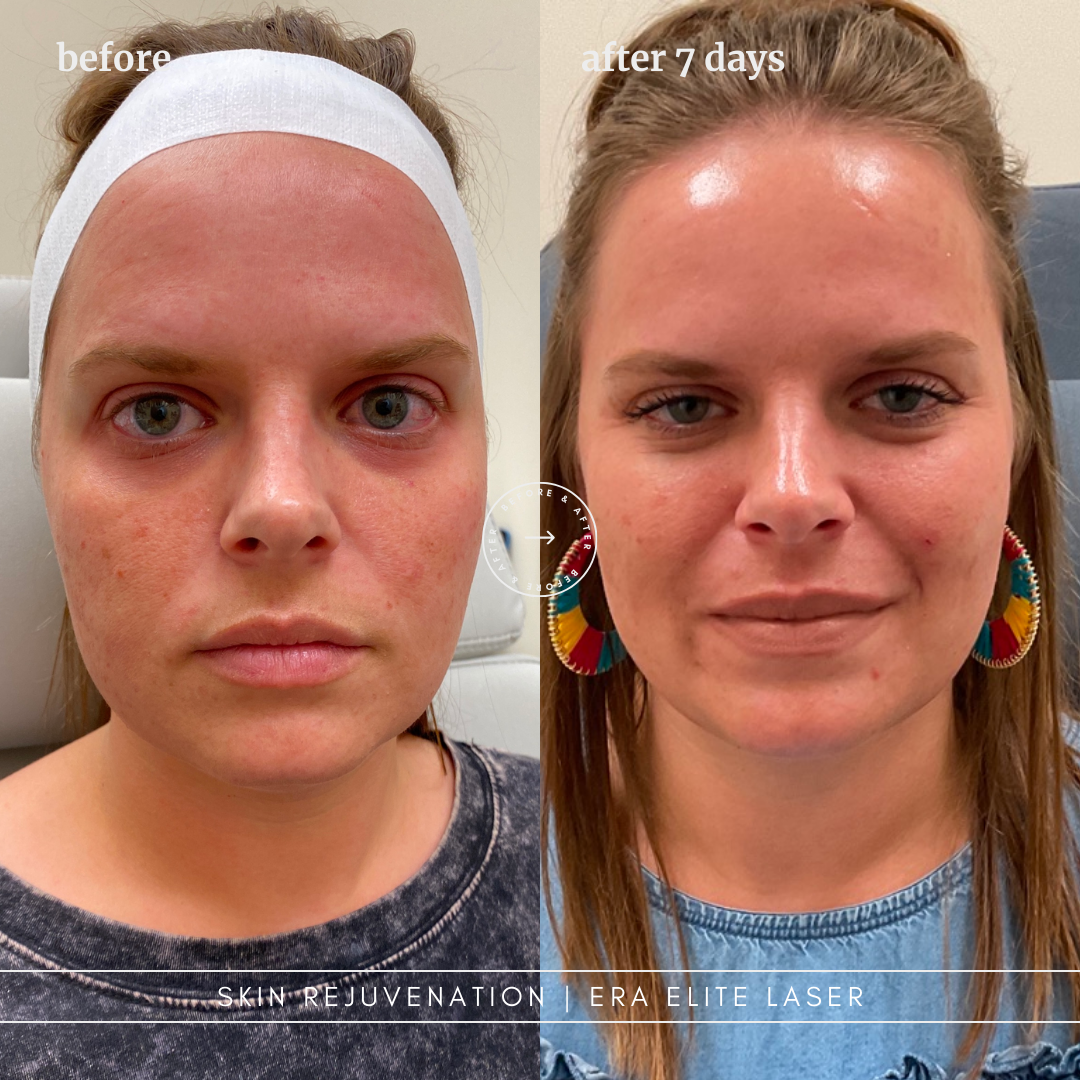 Aerolase Laser Therapy — Excolo Medicine