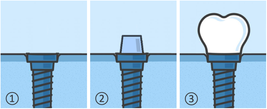 Simply: Implants — Kingsview Dental Clinic
