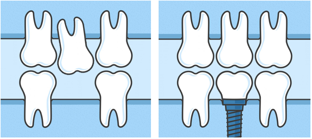 Simply: Implants — Kingsview Dental Clinic