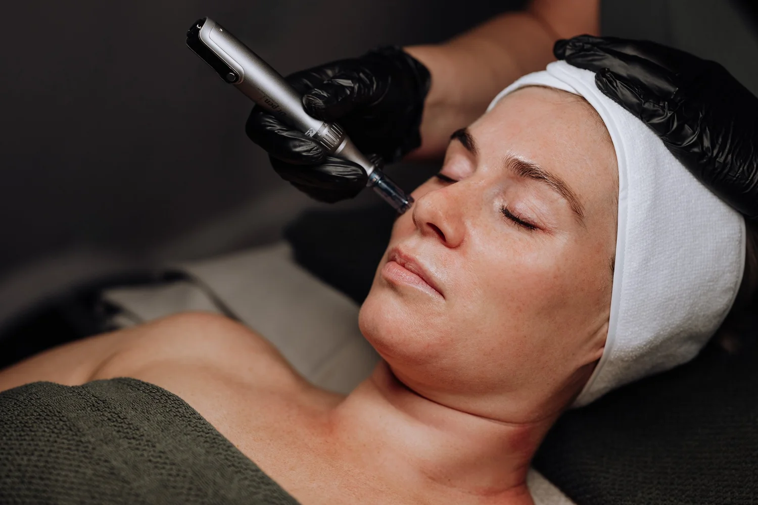 Microneedling Facials — Aesthetics at 51 l Kibworth Skincare