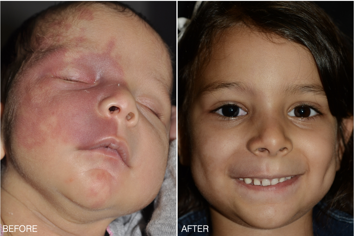 Port Wine Birthmarks Learn More Book Today Miami Dermatology