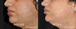 Post-Inflammatory Hyperpigmentation — Miami Dermatology & Laser Institute