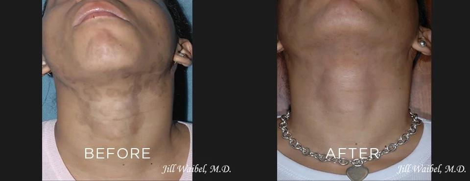 Post-Inflammatory Hyperpigmentation — Miami Dermatology & Laser Institute