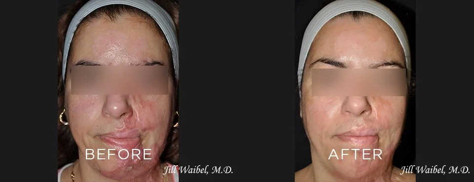 Burn Scars — Miami Dermatology & Laser Institute