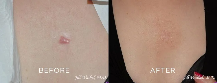 Keloid Scars | Discover Solutions Now — Miami Dermatology & Laser Institute