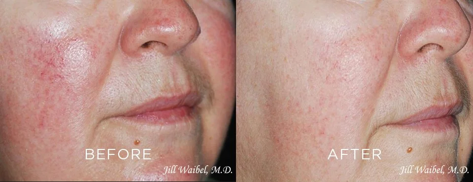 Rosacea | Treat Rosacea Now — Book a Consultation — Miami Dermatology ...