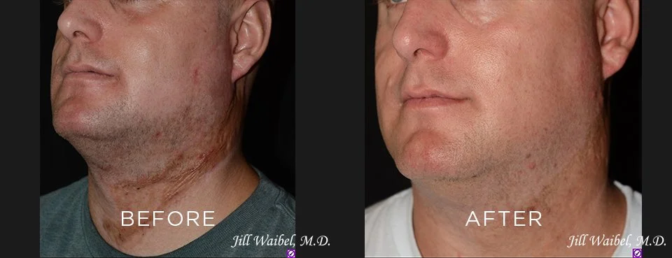 Burn Scars | Improve Your Confidence — Book Today — Miami Dermatology ...
