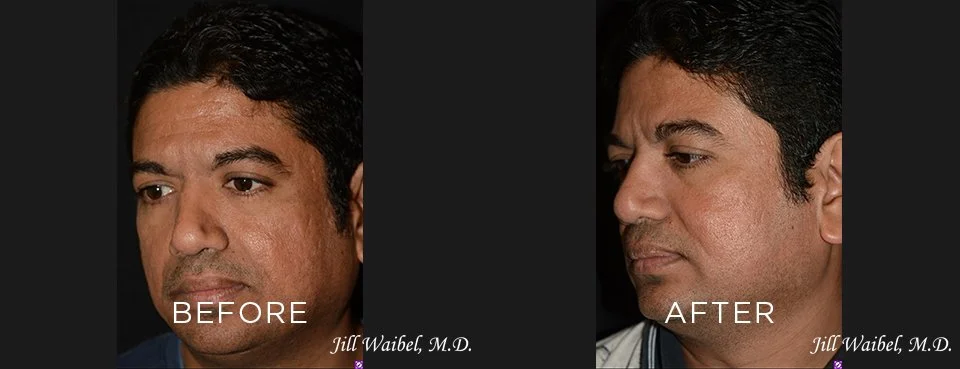 Acne Scars | Discover Clear Skin Now — Miami Dermatology & Laser Institute