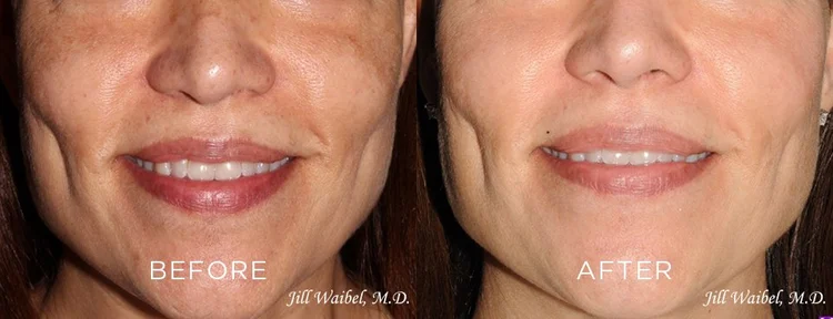 Sun Damage | Restore Skin Health Today — Miami Dermatology & Laser ...