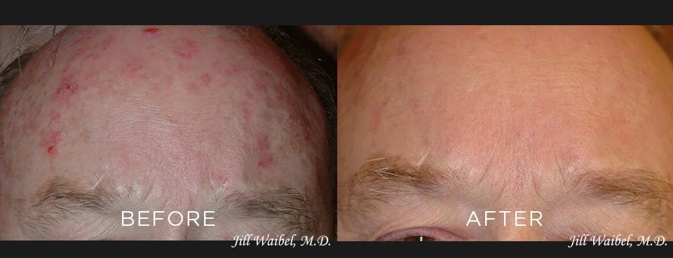 Pre-Cancerous Spots | Prevent Skin Cancer Today — Miami Dermatology ...