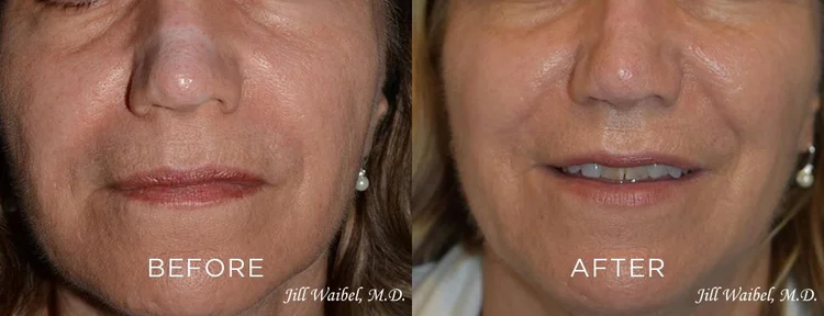 Surgical Scars | Revise & Heal Now — Miami Dermatology & Laser Institute