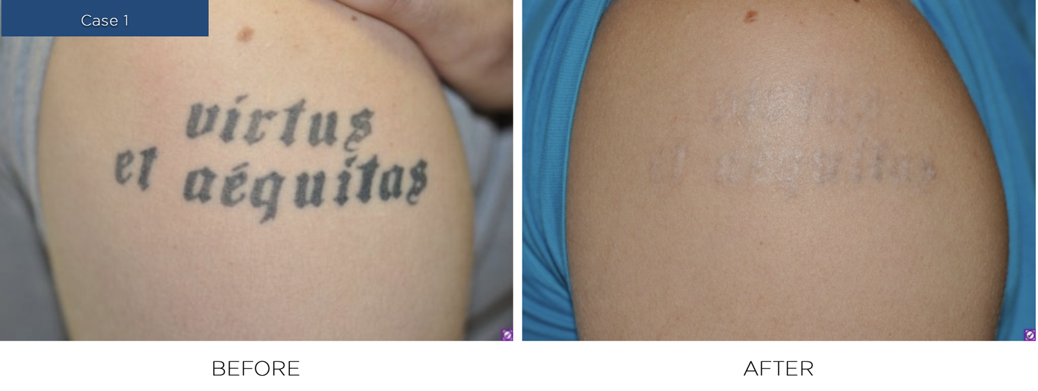 Tattoo Removal — Miami Dermatology & Laser Institute