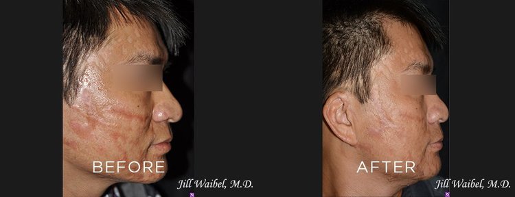 Burn Scars | Improve Your Confidence — Book Today — Miami Dermatology ...