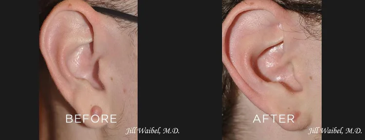 Keloid Scars | Discover Solutions Now — Miami Dermatology & Laser Institute
