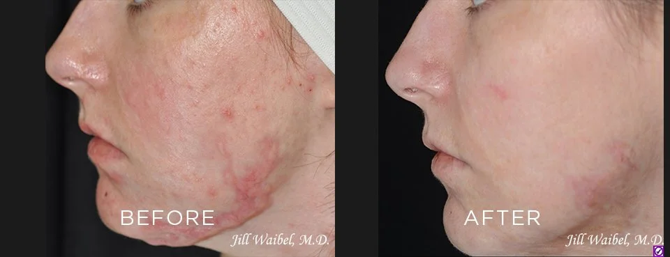 Burn Scars | Improve Your Confidence — Book Today — Miami Dermatology ...