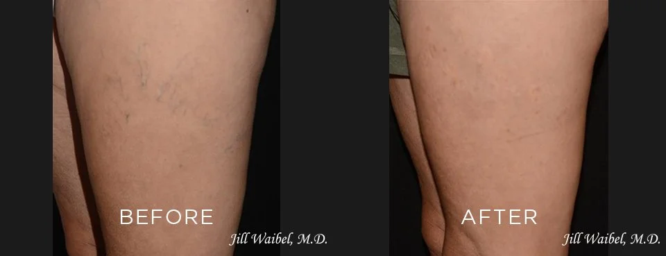 Laser Vein Treatment | Achieve Clear Legs Today — Miami Dermatology ...