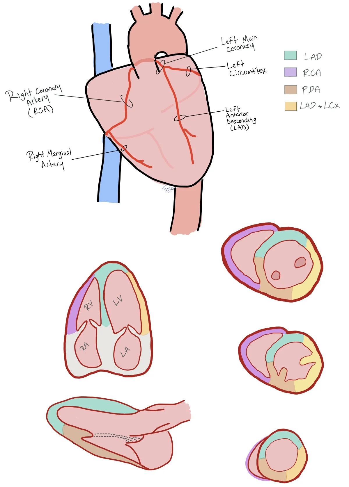 Myocardial Infarction (MI) Complications — When the Beat Drops: A ...