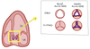 Aortic Stenosis and Heyde’s Syndrome — When the Beat Drops: A Resident ...