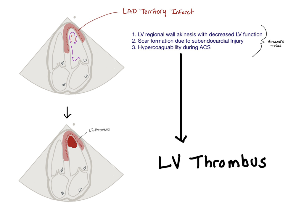 Left Ventricular Thrombus — When the Beat Drops: A Resident's Guide to ...