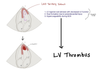Left Ventricular Thrombus — When the Beat Drops: A Resident's Guide to ...