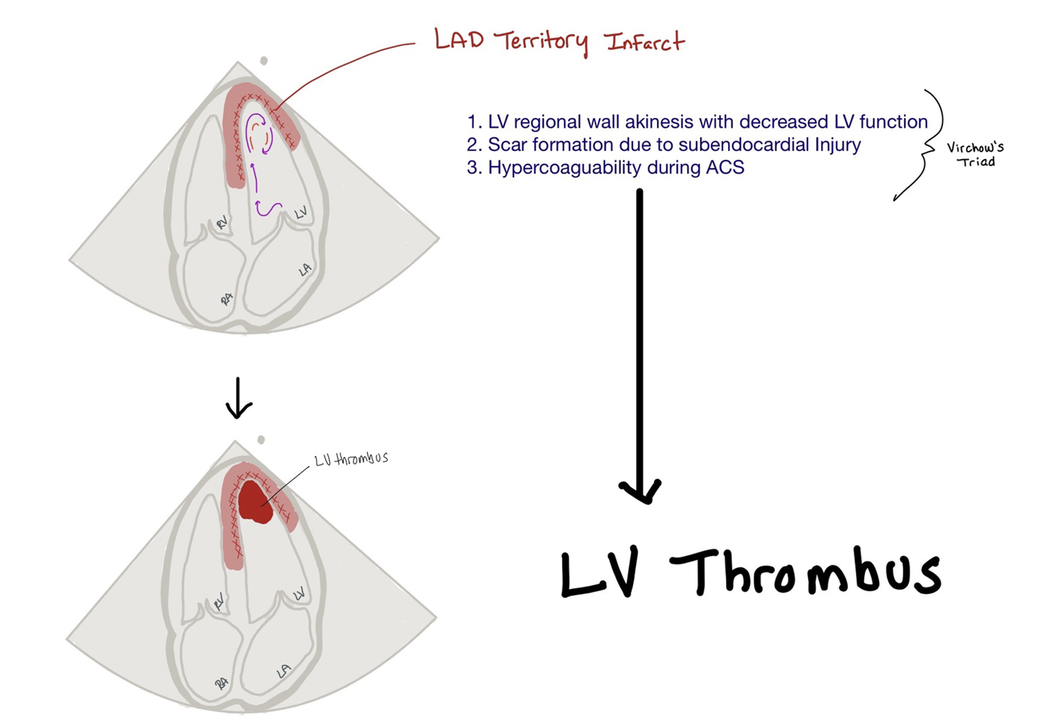Left Ventricular Thrombus — When the Beat Drops: A Resident's Guide to ...